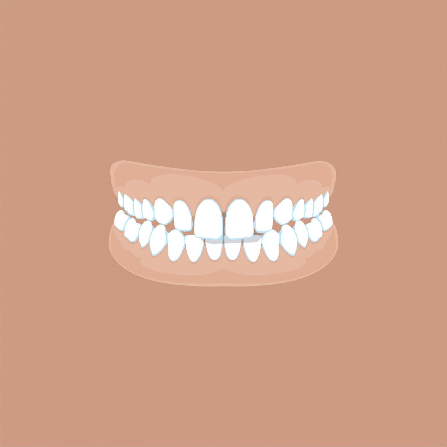 Corinna St Orthodontics: Overbite