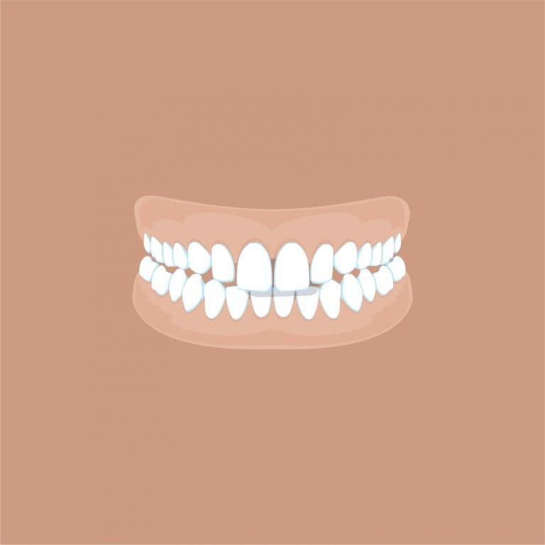 Corinna St Orthodontics: Overbite
