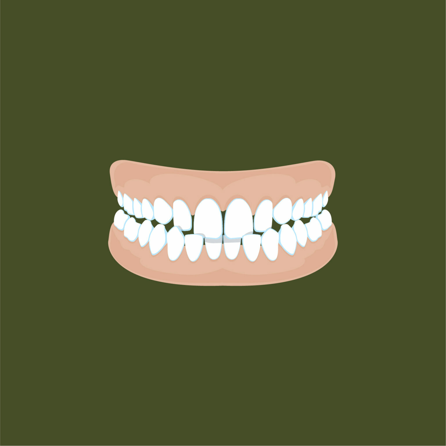 Corinna St Orthodontics: Cross Bite